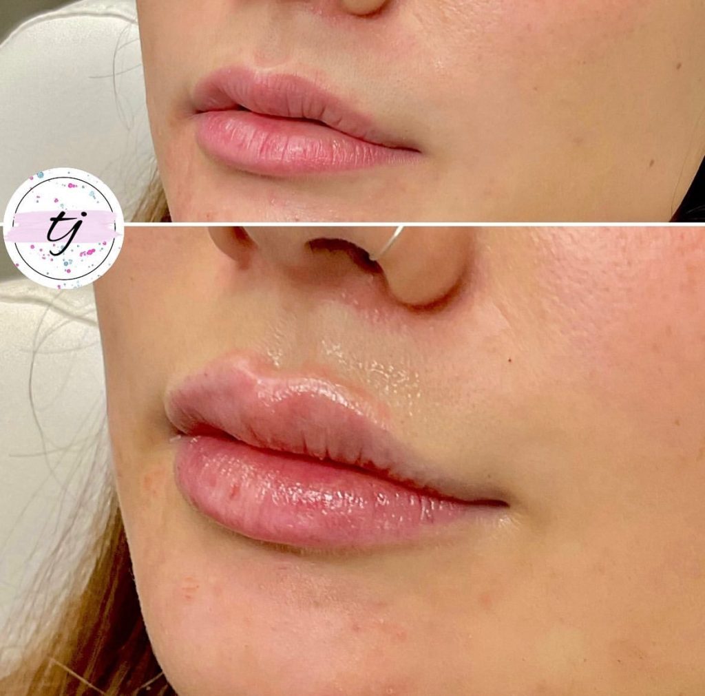 Lip Filler Brentwood TN | Subtle, Natural Lip Enhancements