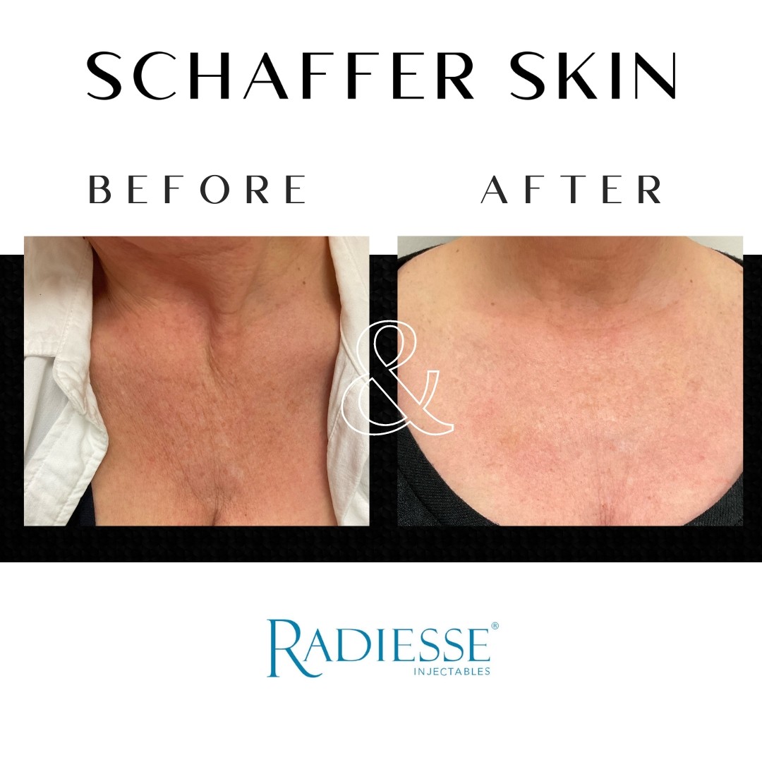 Radiesse Brentwood TN - Schaffer Skin